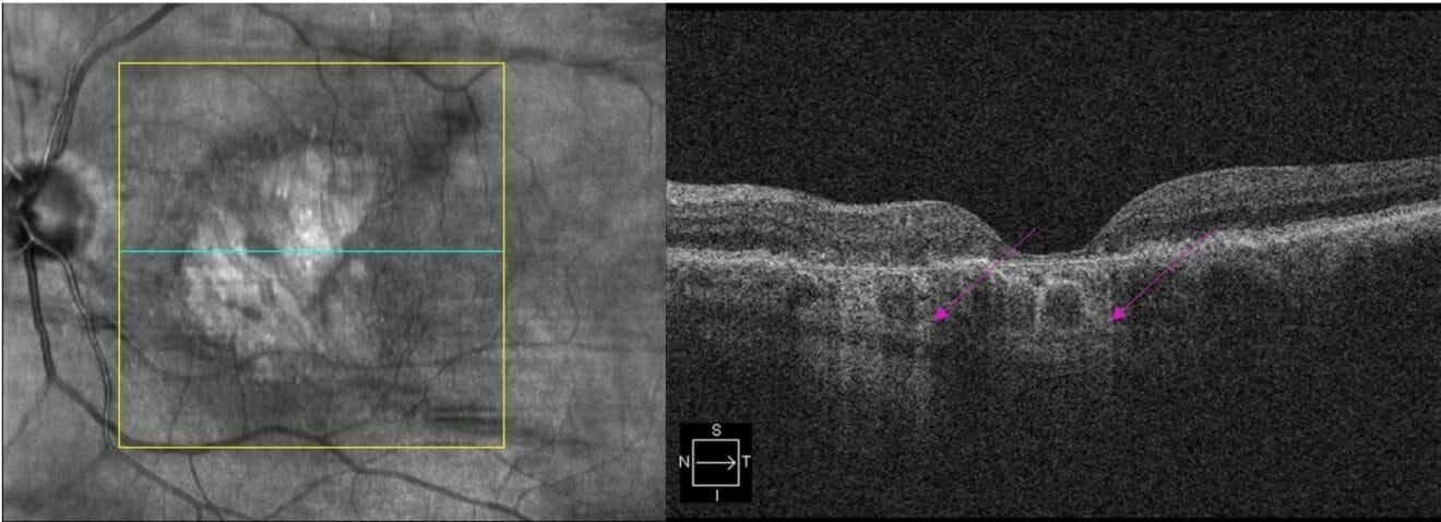 Hope is Now – Understanding Geographic Atrophy (GA) - Review of ...